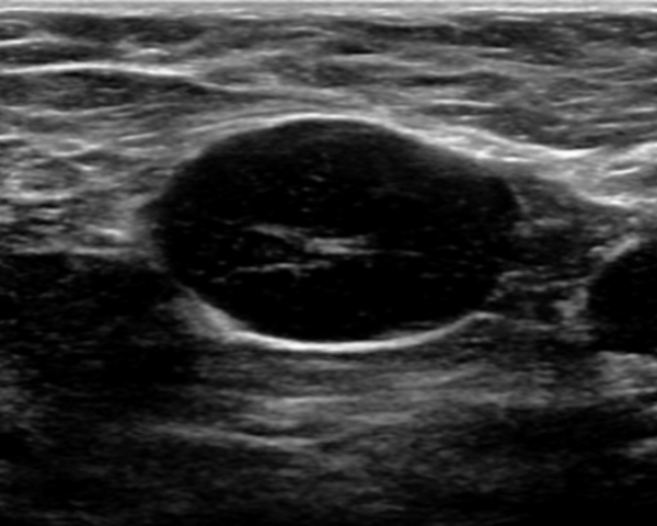 WEBINAR: Estadificación Ganglionar Regional en Cáncer de Mama por ...