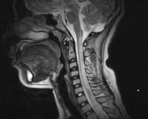 Caso clínico Lesión Medular Cervical. Diagnósticos diferenciales - Telerad